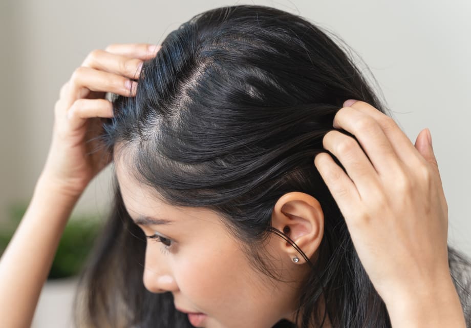 Hormonal hair loss in women: understanding the root cause with Bio-Hair ...